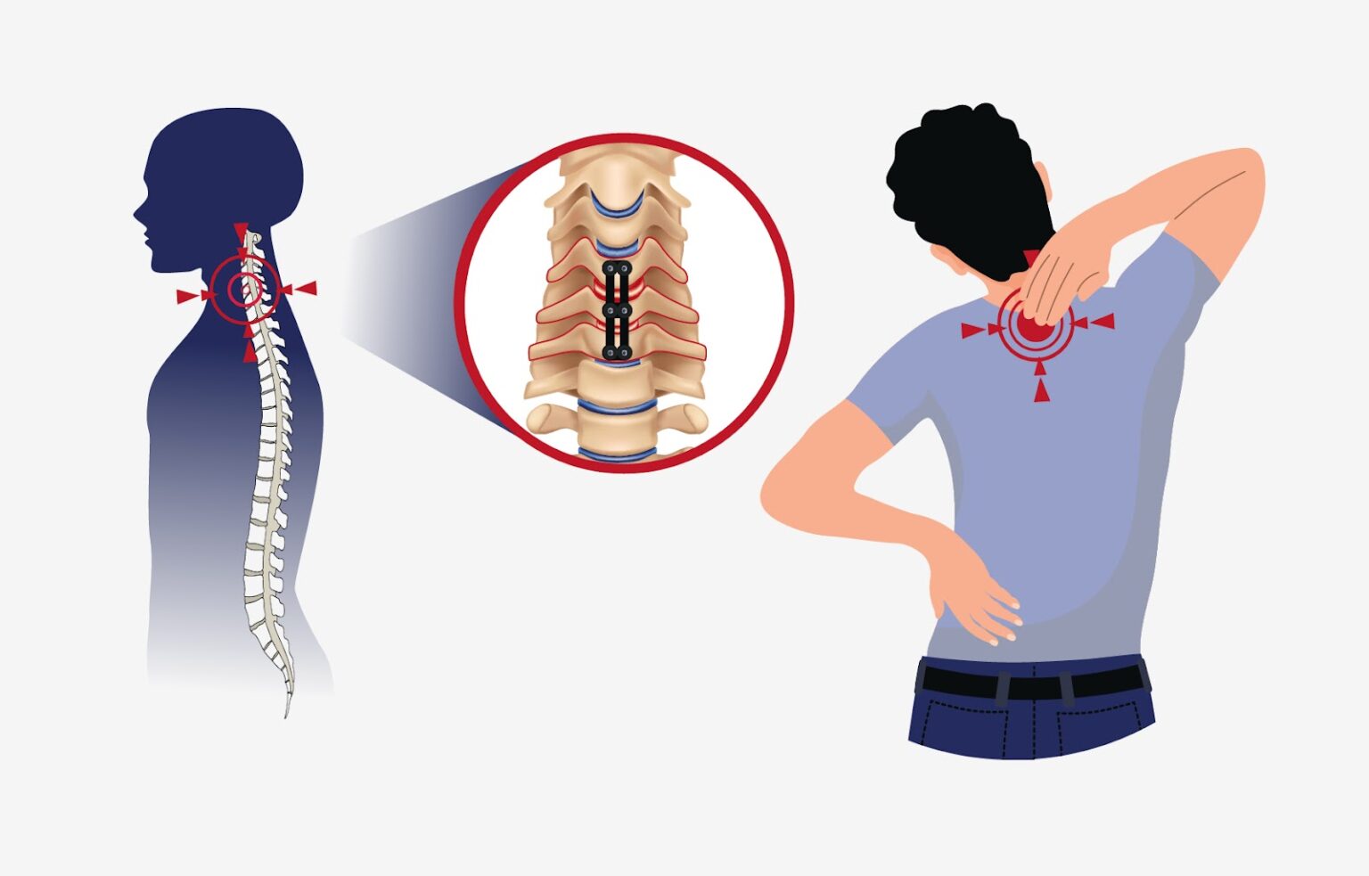 Average Workers’ Comp Neck Fusion Settlement - Matt Fendon Law Group